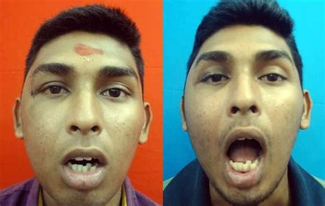 Ryan Benoit Documents Broken Cheekbone Suffered At Ufc 185