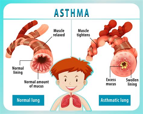 Asthma Diagram With Normal Lung And Asthmatic Lung 3303538 Vector Art At Vecteezy