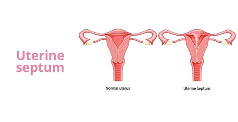 Uterine Septum Symptoms Causes And Treatment