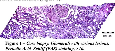 Figure 1 From Smoking Associated Nodular Glomerulosclerosis A Rare Renal Pathology Resembling