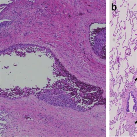 Patients Autopsy Findings Of The Lung Showing A Some Cancer Cells