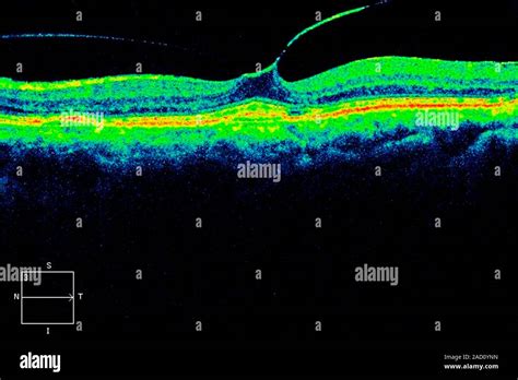 Epiretinal Membrane Optical Coherence Tomography Oct Scan Of A