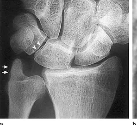 Ulnar Styloid Impaction Syndrome