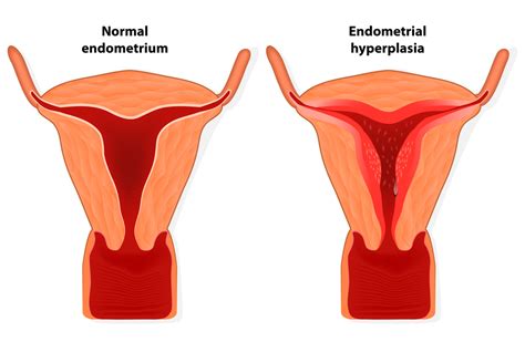 Menorrhagia Menstrual Disorder In Women Reliablerxpharmacy Blog