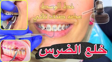 خلع الضرس سحب الناب في تقويم الاسنان Dreslamnabil Teeth Dentist Braces Comedy تقويم