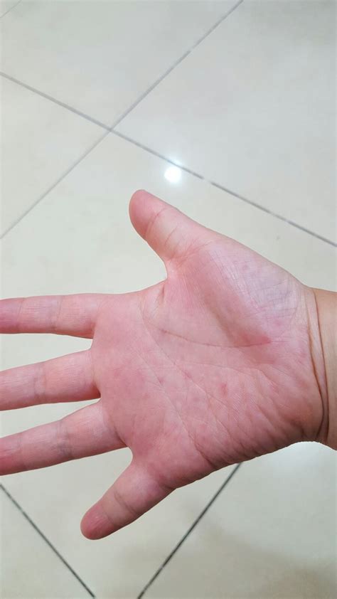피부 빨간반점 두드러기 그리고 소화불량 네이버 블로그