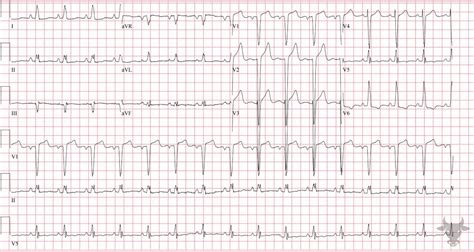T Wave Inversions Ecg Stampede