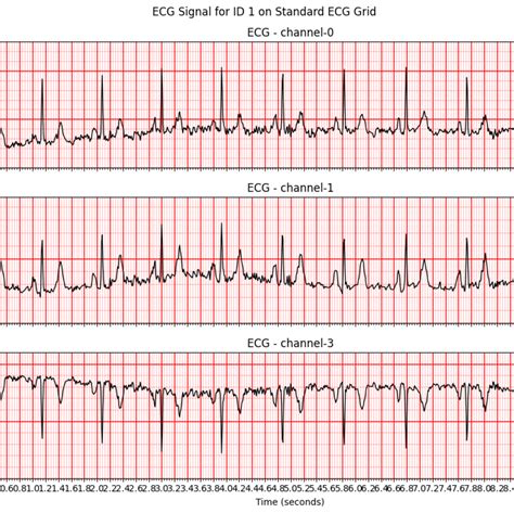 Fluke Simulator Ecg Dataset Kaggle