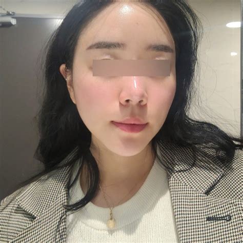 강남 피부과물광주사스킨부스터 릴리이드m맞고 온 실제후기 물광주사 가격붓기통증효과 등 리쥬란 힐러와 차이사진o 네이버 블로그