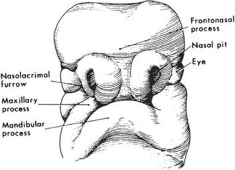 Congenital Craniofacial Anomalies And Their Management Ento Key