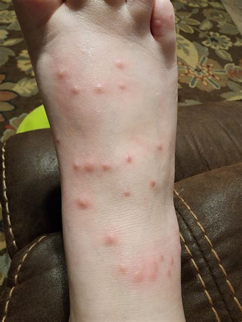 Please Help R Scabies