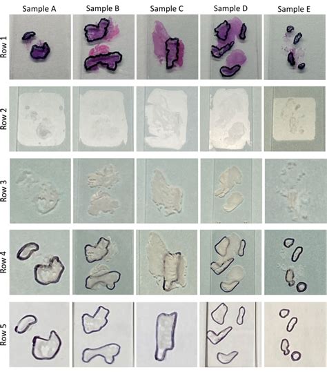 Enhancing Tumor Content Through Tumor Macrodissection Enhancing Tumor Content Through Tumor Macrodissection