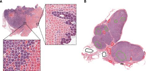 Frontiers Superhistopath A Deep Learning Pipeline For Mapping Tumor