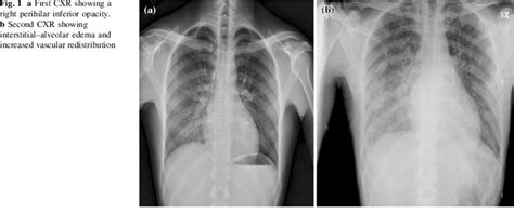 A First Cxr Showing A Right Perihilar Inferior Opacity B Second Cxr