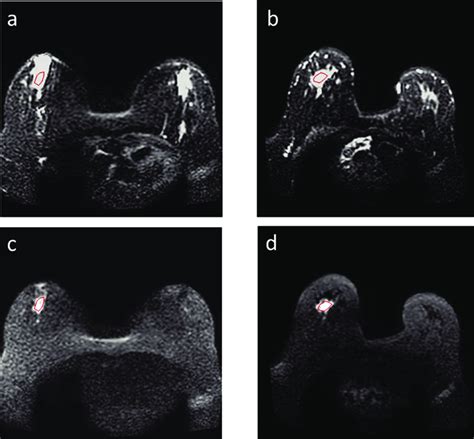 Examples Of Region Of Interest Setting On Breast Diffusion Weighted Download Scientific Diagram