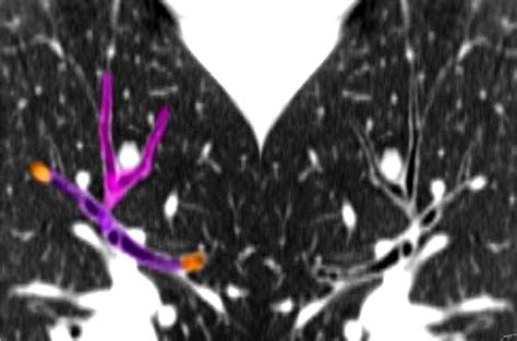 Art Of Broncho Vascular Bundle Lungs