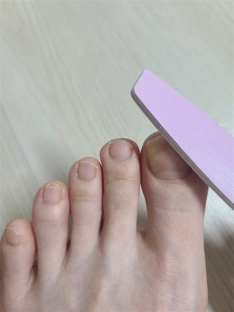 발톱 무좀 치료 방법 전부다 알려드릴게요 네이버 블로그