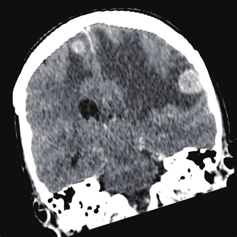 Lobulated 5 Cm Lung Mass In The Left Lingula Involving The Diaphragm
