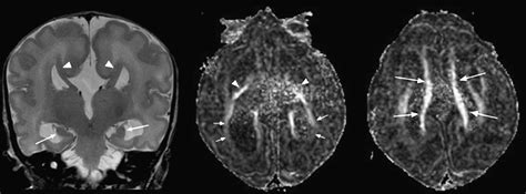Diffusion Tensor Imaging For Brain Malformations Neuroimaging Clinics
