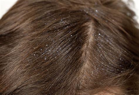 Dandruff Causes Treatment Weldricks Pharmacy