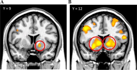A The Activation In The Ventral Striatum Correlates Positively With The