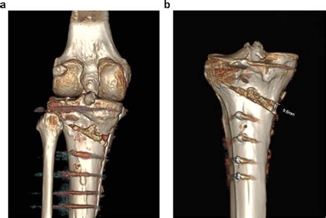 Display Of Osteotomy Area In Anterior And Posterior Position By
