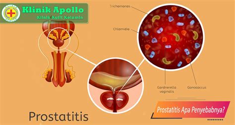 Prostatitis Apa Penyebabnya Kenali Gejalanya Klinik Apollo Jakarta