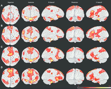 Global Statistical Parametric Mapping Software Analysis Showing A Download Scientific Diagram