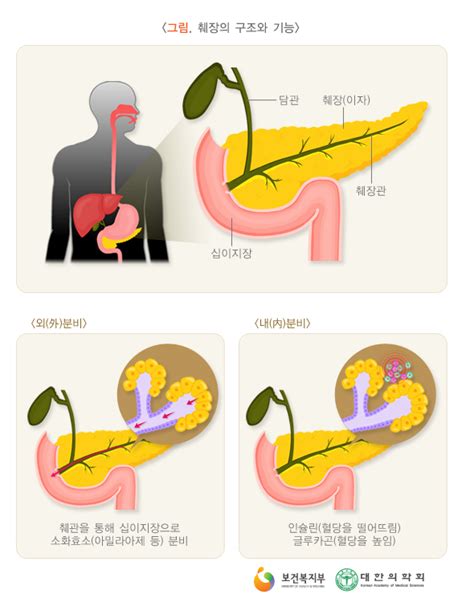 췌장암 위험 높은 췌장 물혹췌장낭종 네이버 블로그