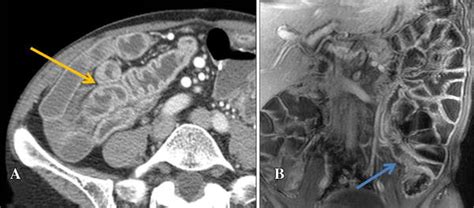 A Axial Cte Showing Findings Of Ulcerative Jejunitis In A Type Ii Rcd Download Scientific