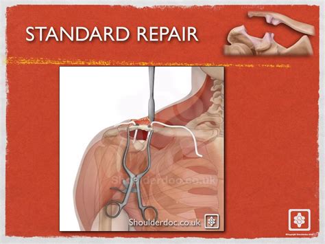 Ac Joint Dislocation Open Repair Lennard Funk Ppt