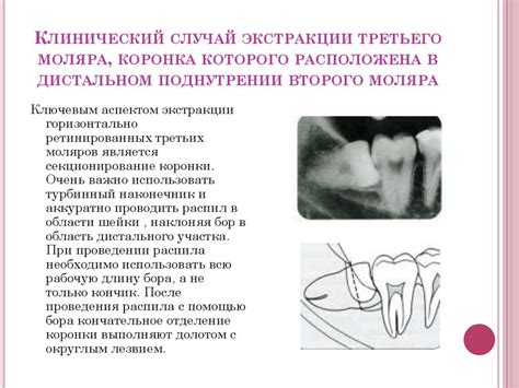 Удаление третьих моляров верхней и нижней челюсти. Ретенция и дистопия ...