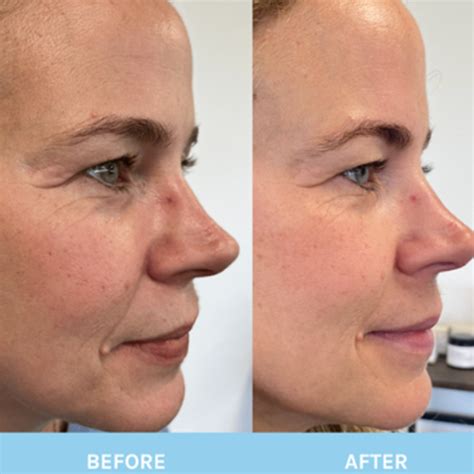 Evolve Lifting Serum Age Defying And Wrinkle Reducing