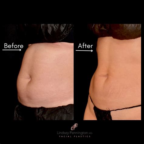 Coolsculpting Before And After Photos Lindsey Pennington Md