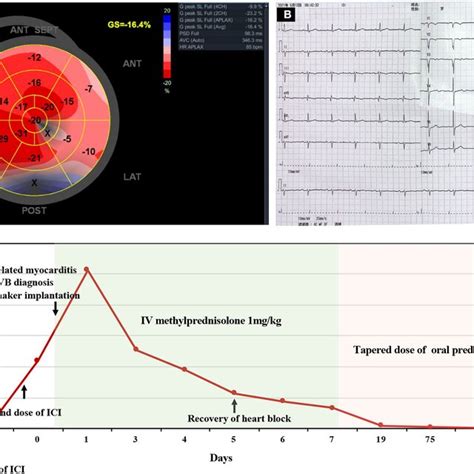 Electrocardiogram And Myocardial Contrast Echocardiography A Download Scientific Diagram