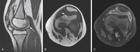 Approach To Pediatric Soft Tissue Masses Radiology Key