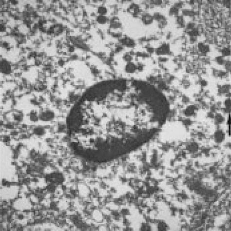 Tumor Cells Arranged In Characteristic Zellballen Pattern Around A