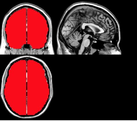 Data Processing Assistant For Resting State Fmri Dparsf The R Fmri