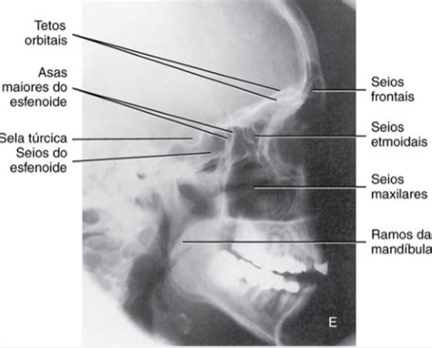 Dicas De Radiologia Tudo Sobre Radiologia TÉcnicas RadiolÓgicas Rx