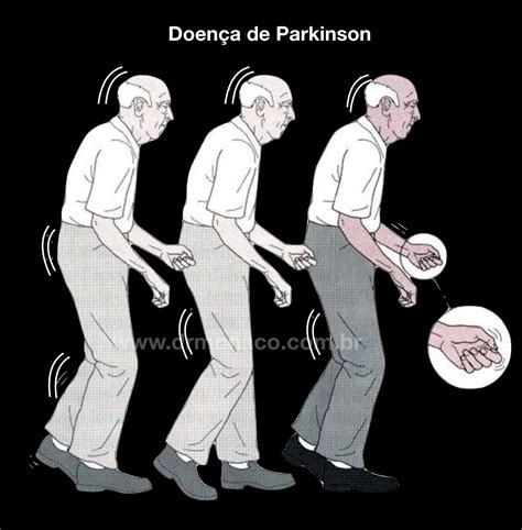 Tratamento Da Doença De Parkinson