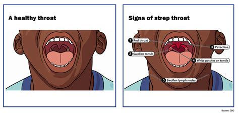Strep Throat Vs Sore Throat