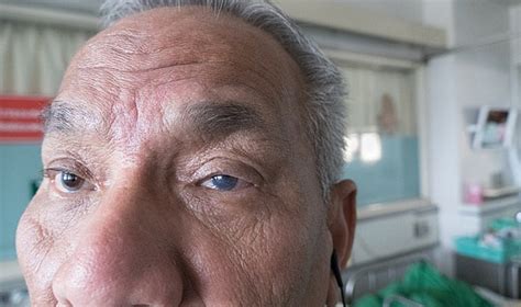 Keratopathy Bullous Condition In Eye Of Elderly Patient Before Penetrating Keratoplasty Photo