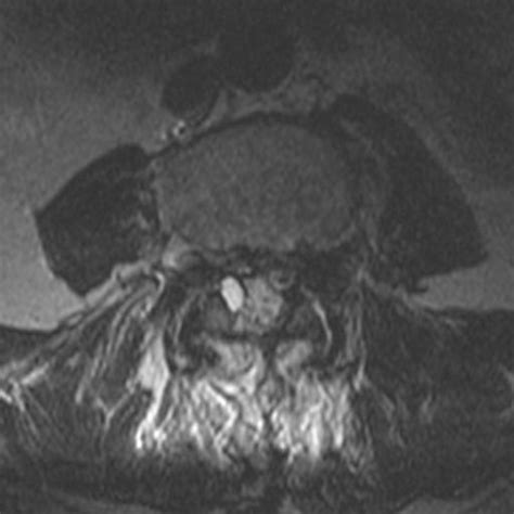 Lumbar Synovial Cysts Neurorad911 Lumbar Synovial Cysts