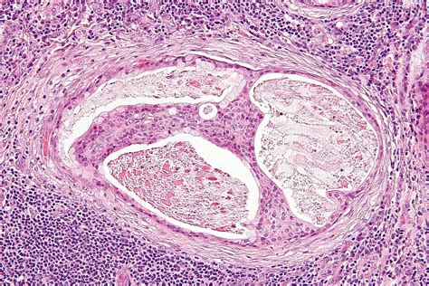 Filemucoepidermoid Carcinoma 2 High Mag Libre Pathology