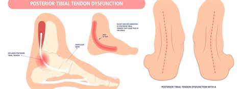 Tibialis Posterior Tendon Dysfunction Matthew Appleton