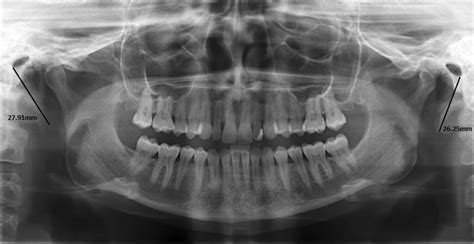Linear Measurements On Panoramic Radiograph Download Scientific Diagram