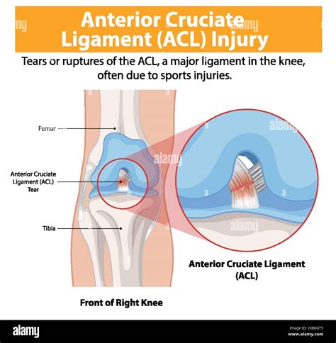 Illustration Of Acl Tear In The Right Knee Stock Vector Image And Art Alamy