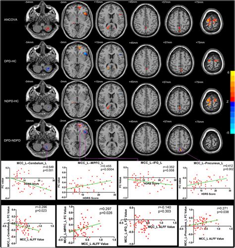 Statistical Parametric Map Showing The Significant Differences In The