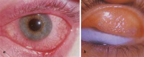 Adenoviral Keratitis