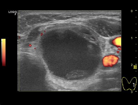 Thyroid Nodule Ultrasound